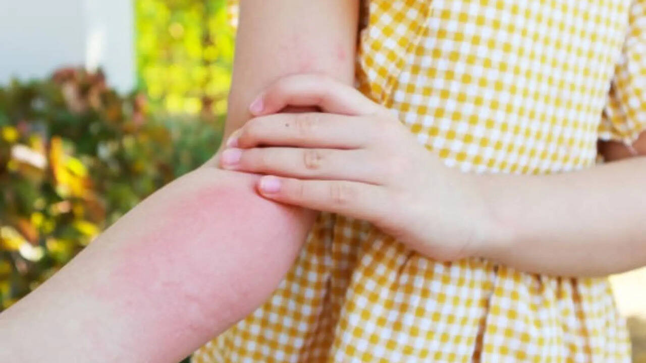 Monsoon Skin Health: How Rainy Weather Can Lead To Infections And Ways ...