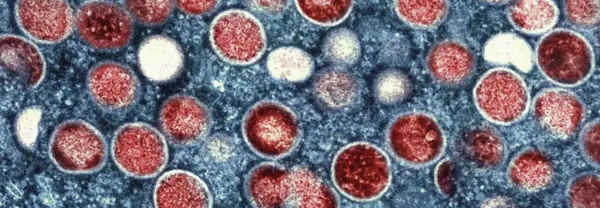 Monkeypox In Sweden: Sweden Reports First Case of Mpox As The Infection ...