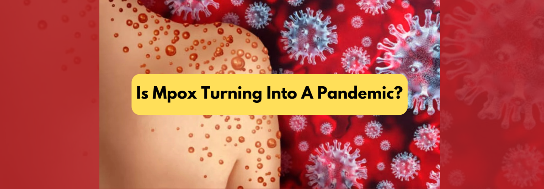 Mpox Virus Outbreak: Is Mpox Turning Into A Pandemic? Experts Share ...