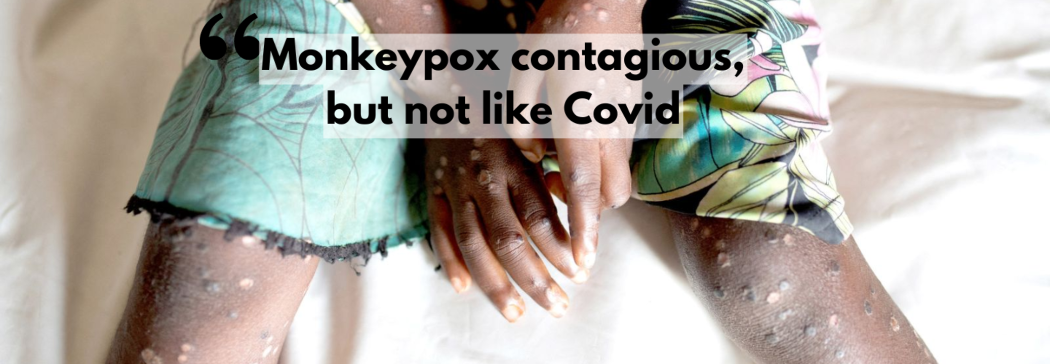 Mpox Is Contagious But Not Like COVID: Key Differences, Risk Factors ...