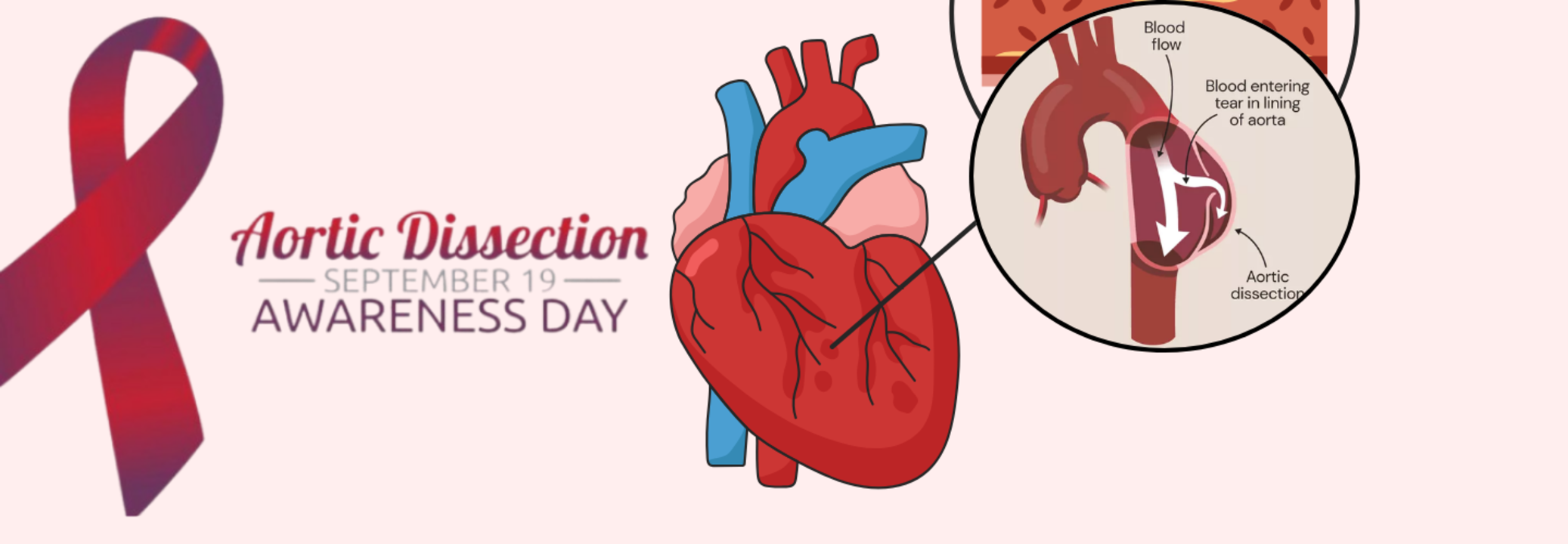 Aortic Dissection Awareness Day 2024: Know The Key Facts About This ...