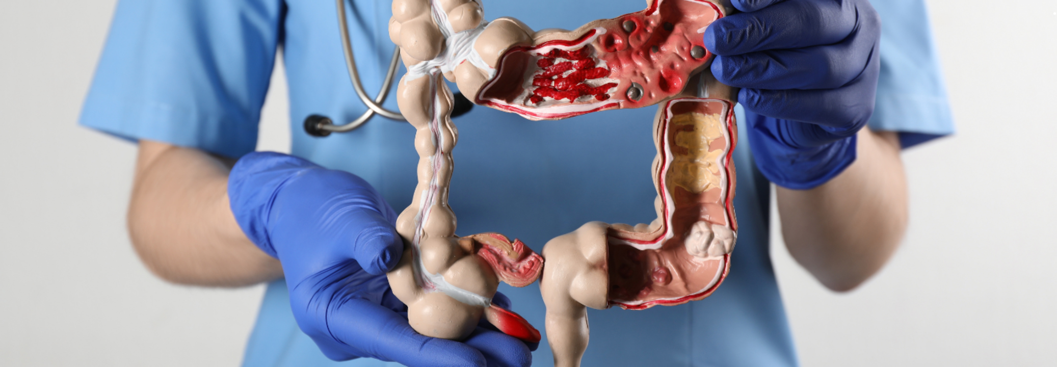 Colon Cancer Is The 8th Most Common Among Indian Men, Know Its Symptoms ...
