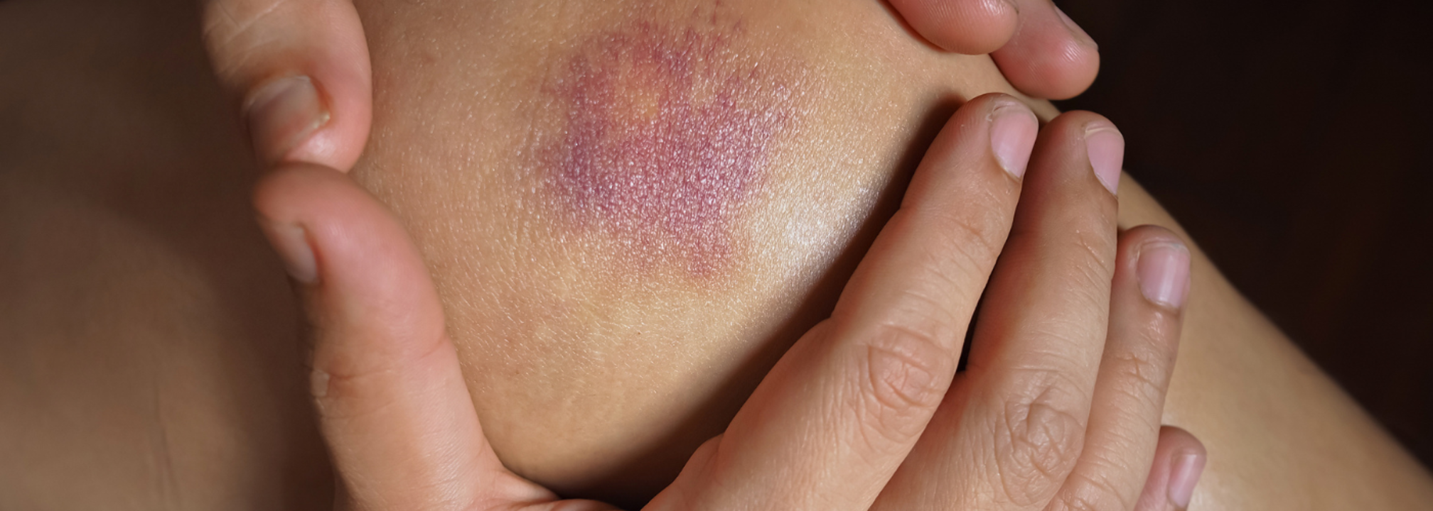 Why Am I Bruising So Easily? | Health and Me