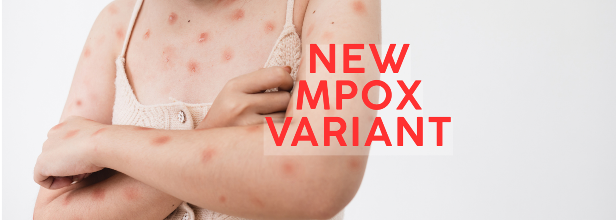 New, More Contagious Mpox Variant Detected In Germany, Disease Control ...