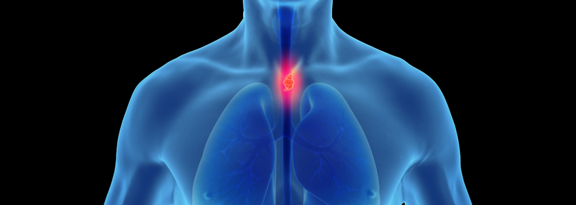 Why India’s Fourth Most Common Cancer Is A Growing Concern | Health and Me