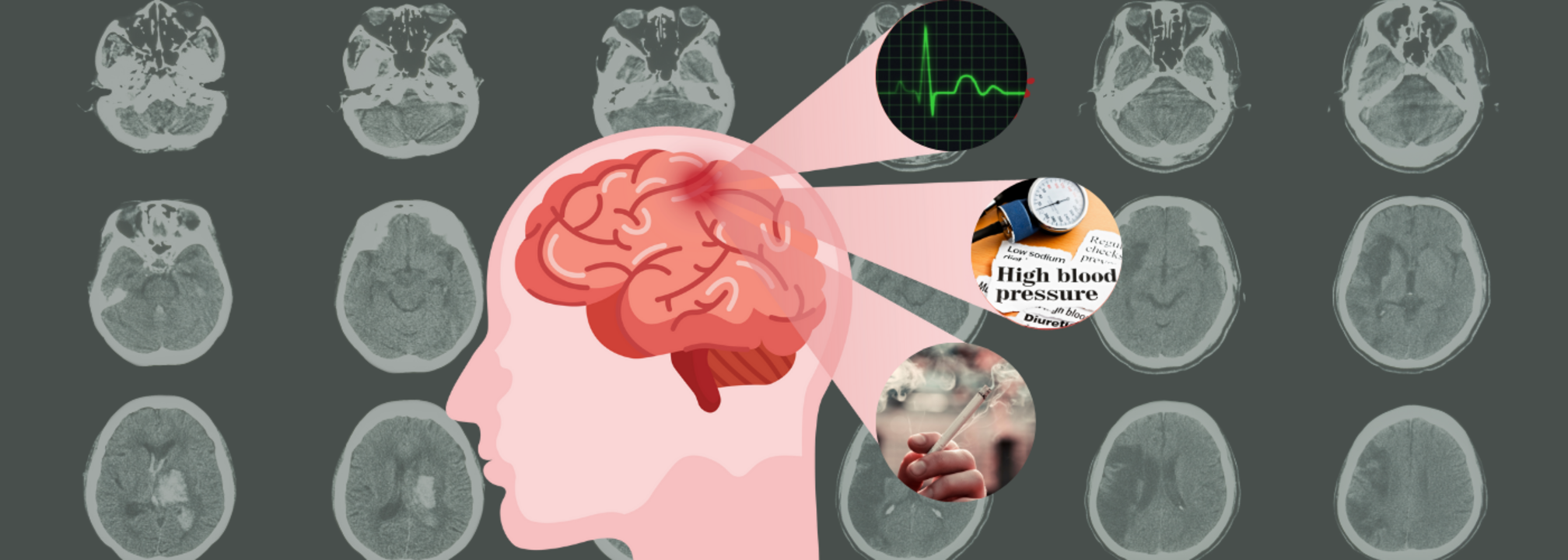 3 Shocking Stroke Risk Factors You Need To Control NOW | Health and Me