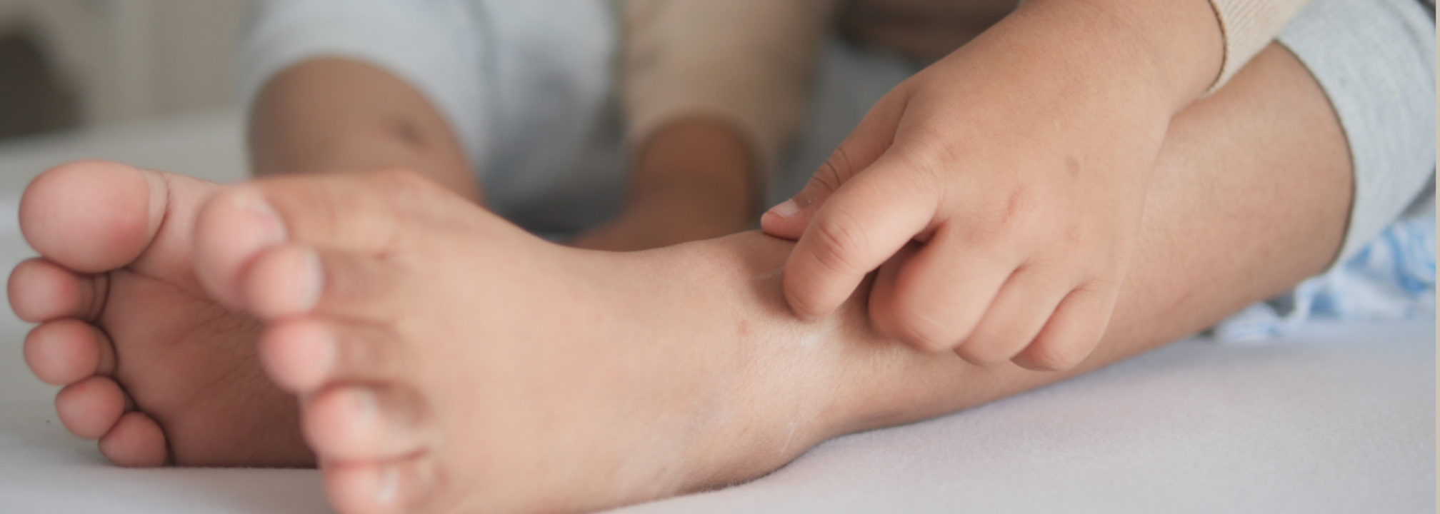 Bug Bites On Your Feet? Tips To Relieve The Itch And Swelling | Health ...