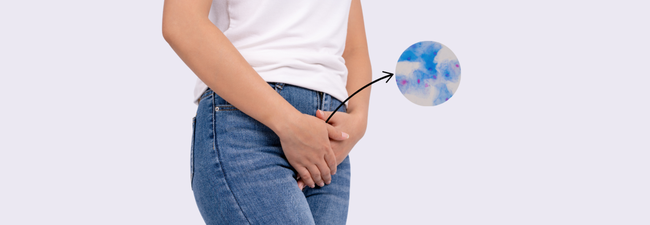 Blue Waffles Disease Symptoms , Causes , Treatment and Real STI ...