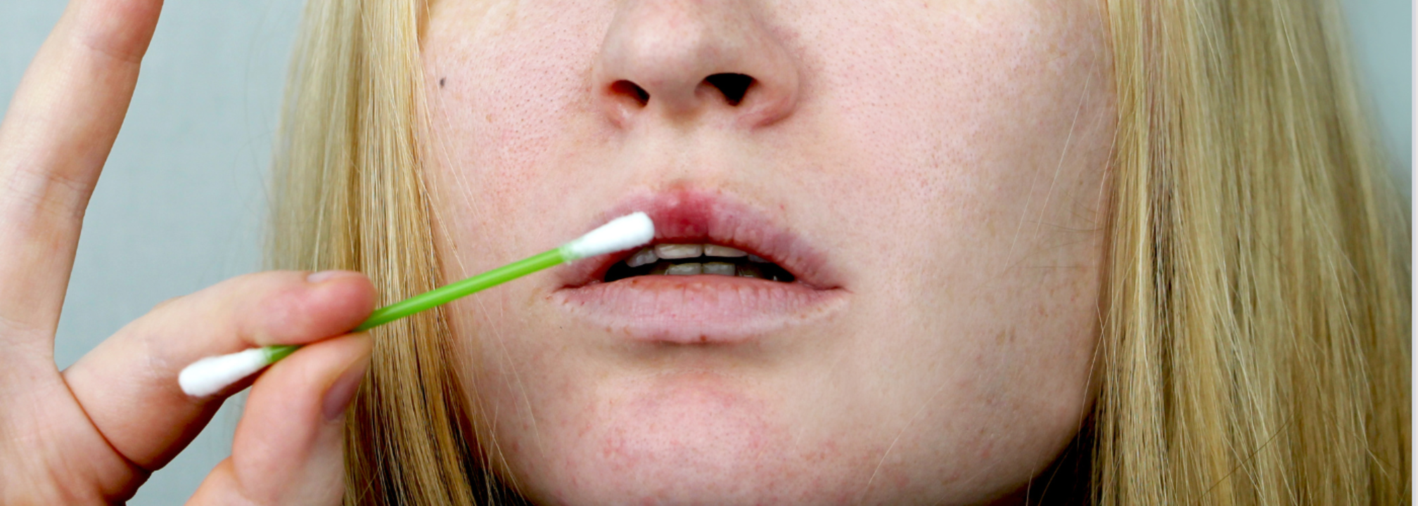 Syphilis Cases Rise To Record Highs Across US, CDC Reports Alarming ...