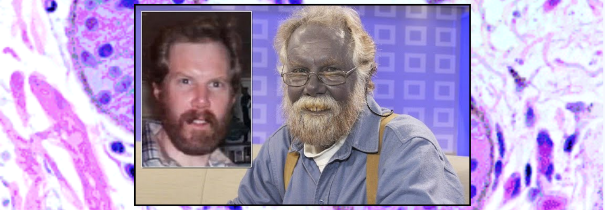 Smurf Syndrome: Rare Condition That Turns Your Skin Blue-Gray ...