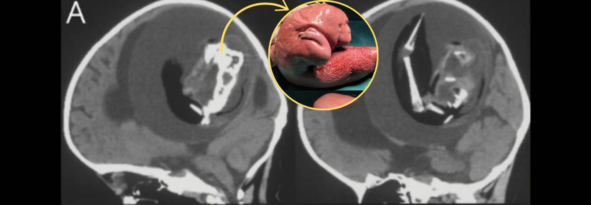 In An Extremely Rare Surgery, Doctors Remove Fetus From A 1-Year-Old ...