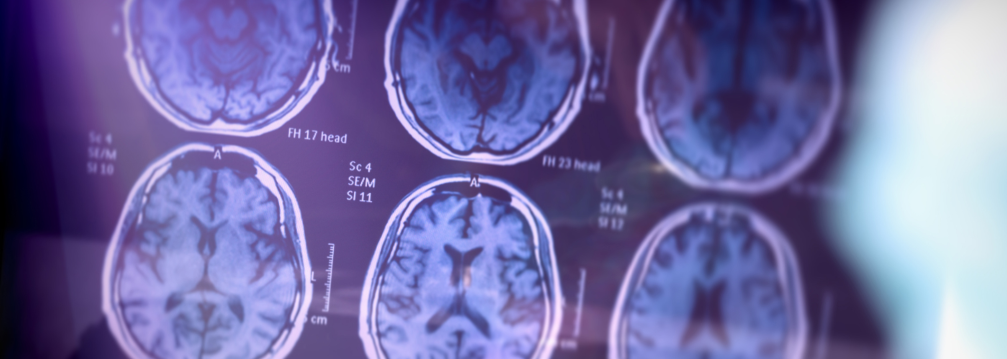 Is 'Sticky Gunk' In Your Brain The Reason Behind Alzheimer's Disease ...