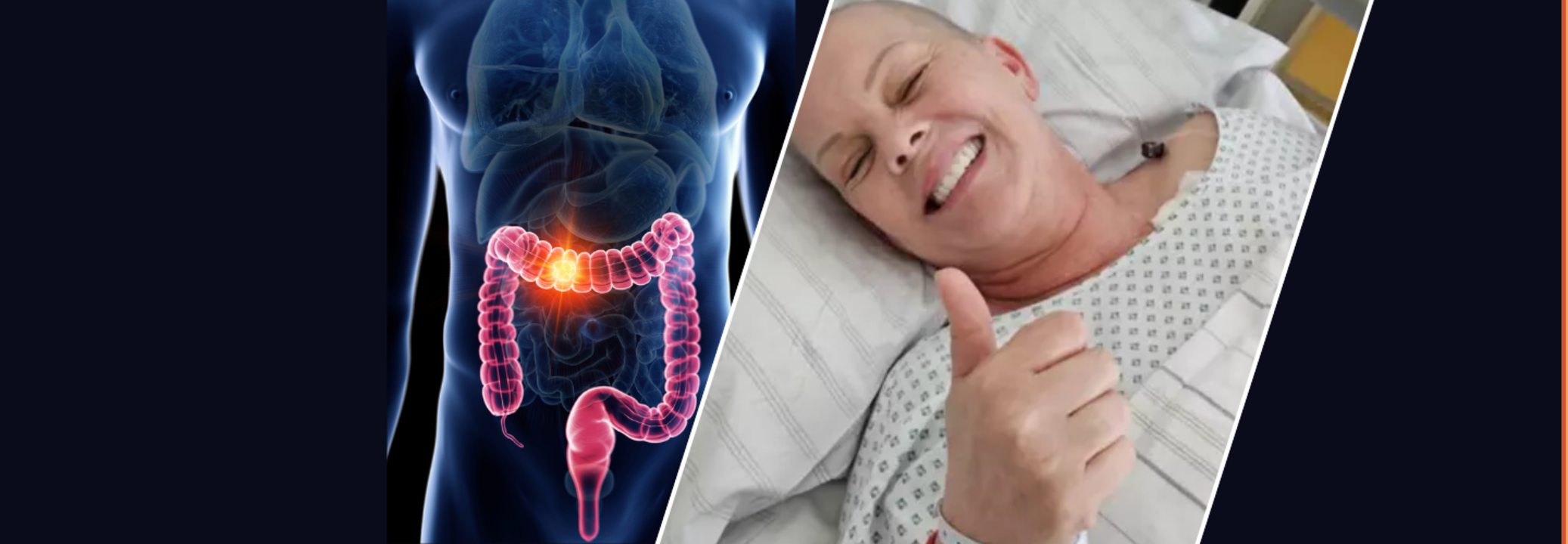 ‘Fit and Healthy’ Woman Diagnosed With Terminal Colon Cancer- Her ...