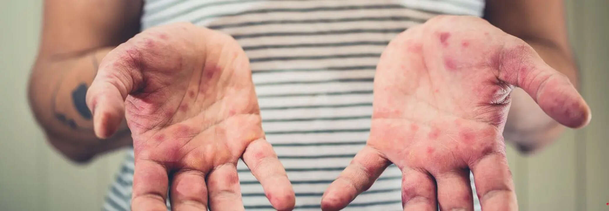 6 Test Positive For Measles In Texas As RFK Jr Touts Vitamin A As ...