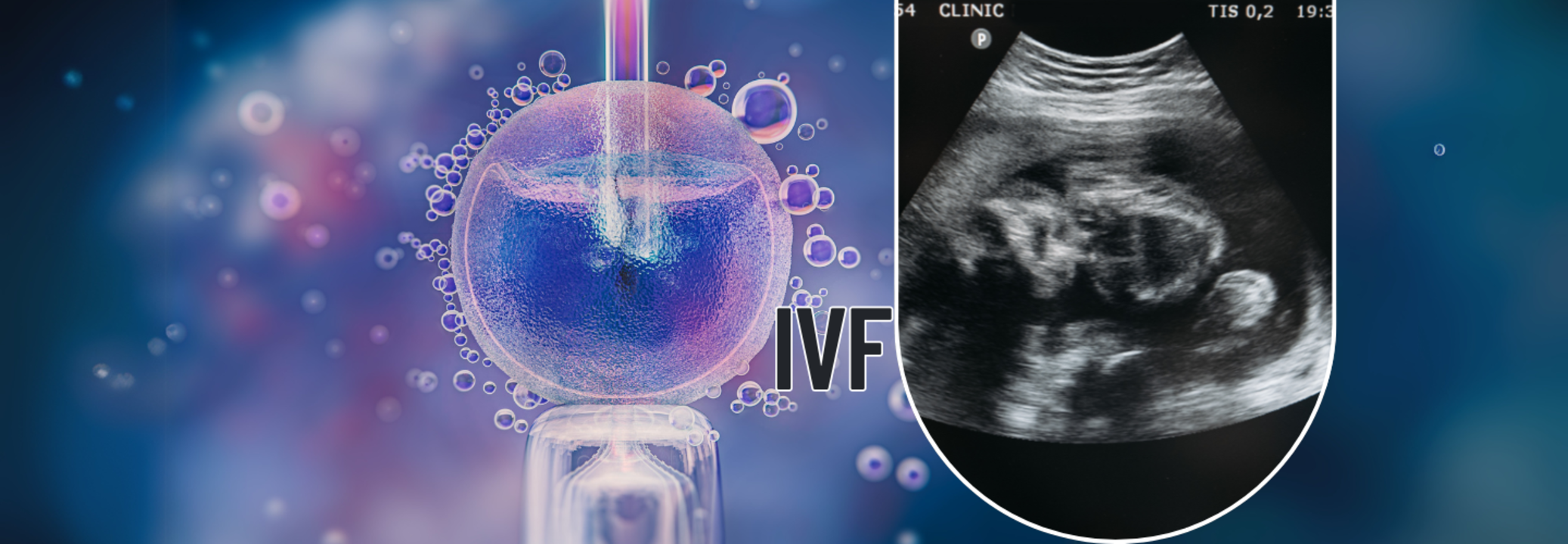 IVF: What Is The Right Age To Start, How Many Times You Can Try And ...