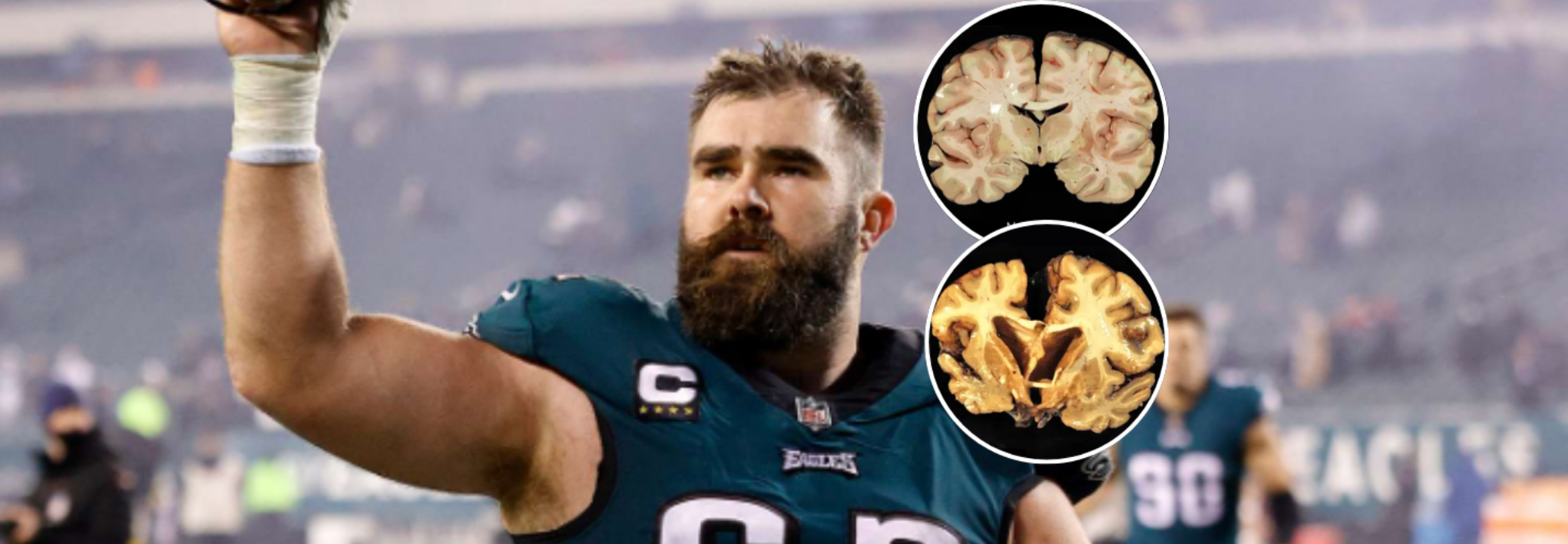 Jason Kelce Says He ‘Virtually Guarantees’ He Has CTE; Know All About ...