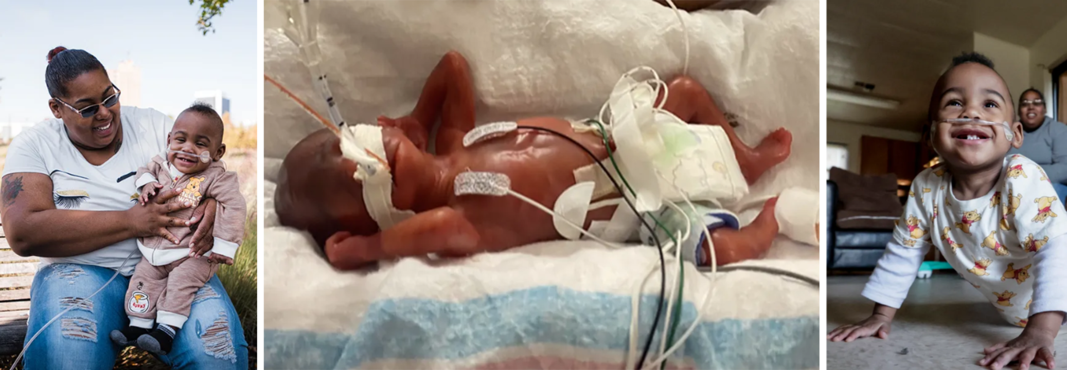 With Less than 1% Survival Chance, The Baby Born At 21 Weeks Survives ...
