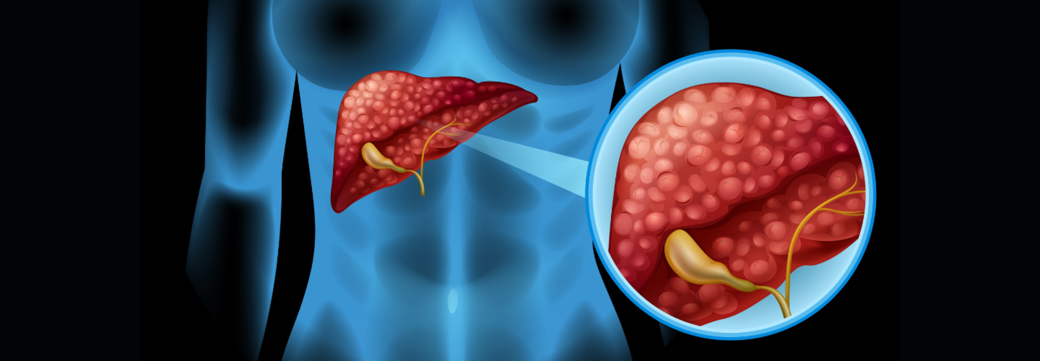 This Deadly Liver Disease Is Affecting People In Their 20s And This One ...