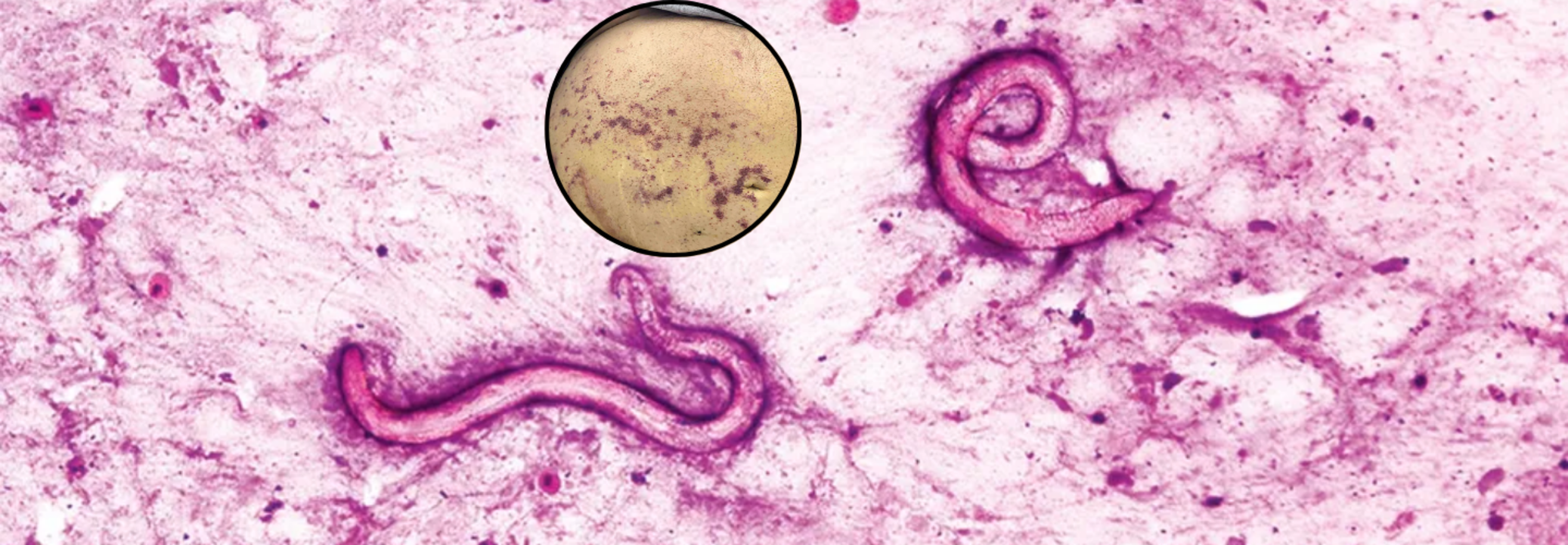 Man Battles Deadly Parasites 'Crawling In His Body' After Kidney ...