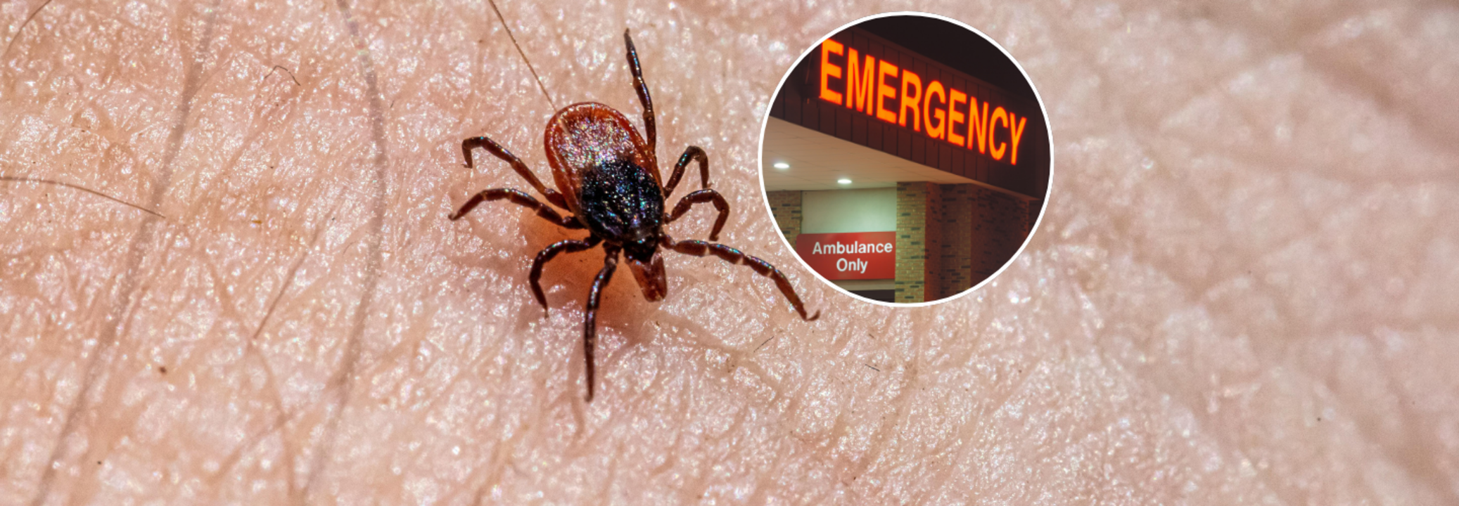 Why More Americans Are Landing In ERs Over Tick Bites This Year? Here's ...