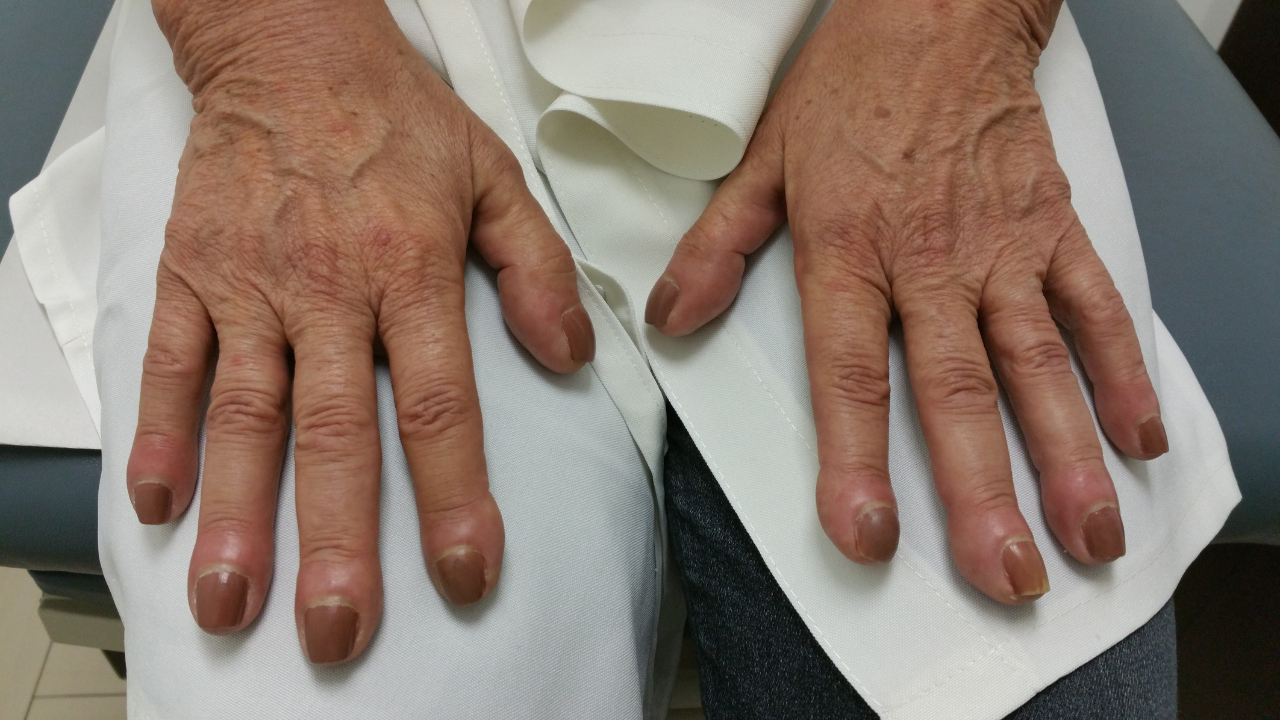 What Is Nail Clubbing, and Could It Be a Sign of a Serious Disease ...