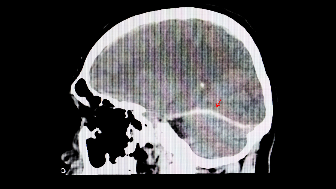 Manhattan Shooter Cited CTE in Suicide Note: Here Is What the Condition ...