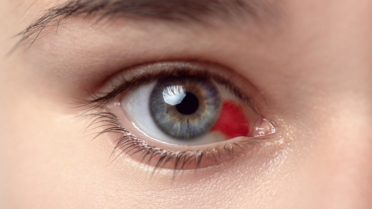 My Eye Is Bleeding? What Does It Mean When You Have A Big Red Patch On ...