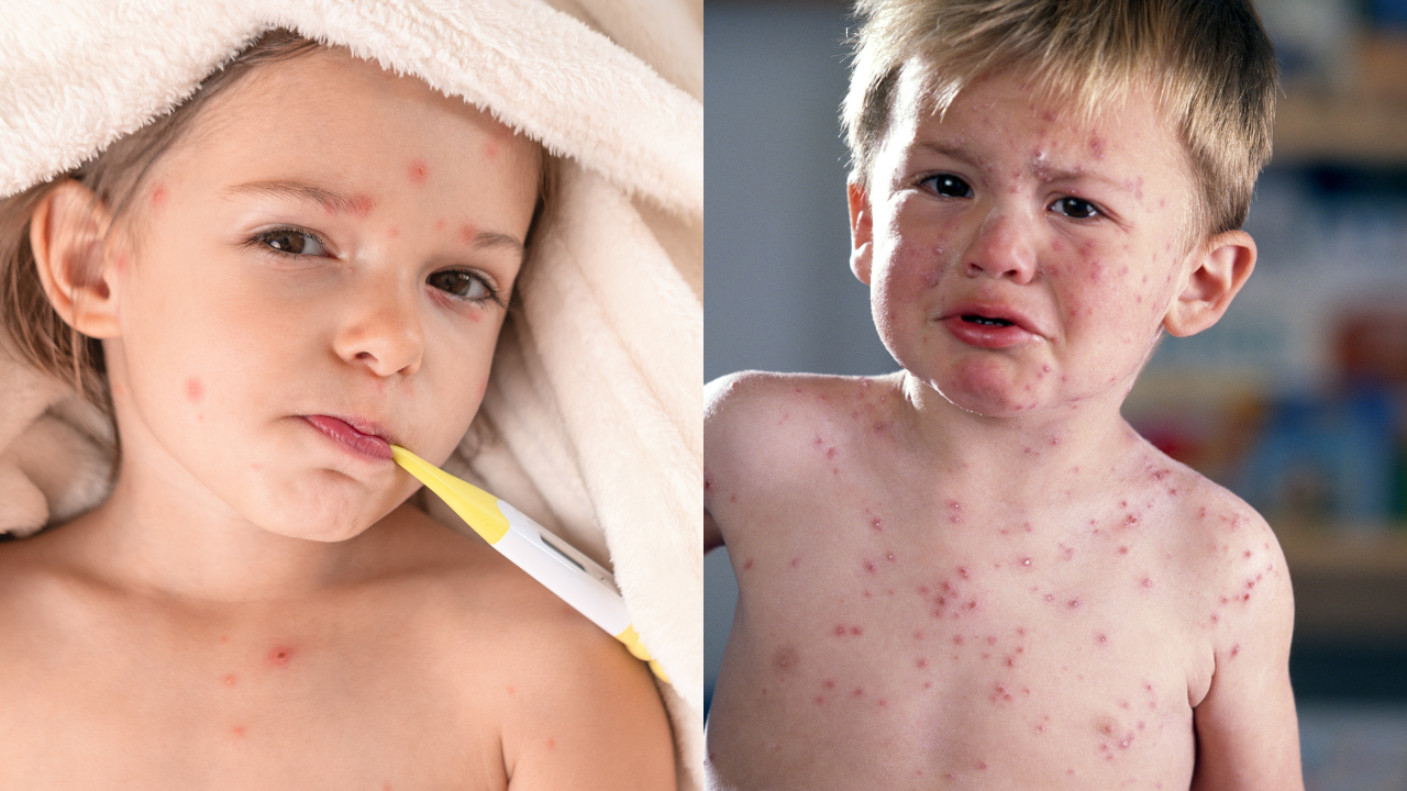 UK Children To Get Chickenpox Vaccine On NHS: Why It Is A Lifesaver Vaccine | Health and Me