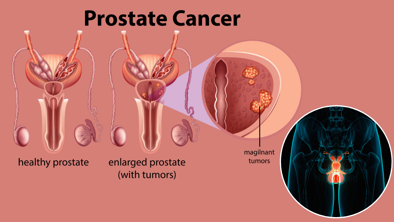 Prostate Cancer Rates Climb Again After A Decade Of Decline: 80% Of ...