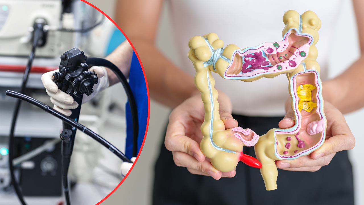 Simple Stool Test Can Reveal Colorectal Cancer With 90% Accuracy: Could ...