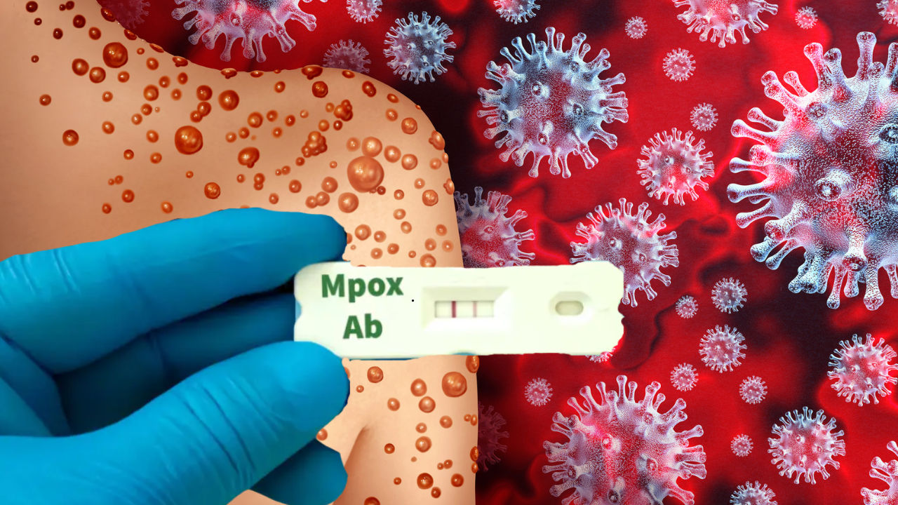 New Mpox Strain Detected In England; It Is A Mix Of Clade Ib and Clade ...
