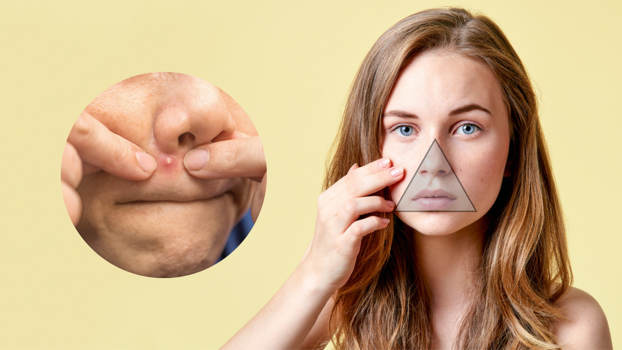 The “Triangle of Death” on Your Face: Why You Should Never Pop a Pimple ...