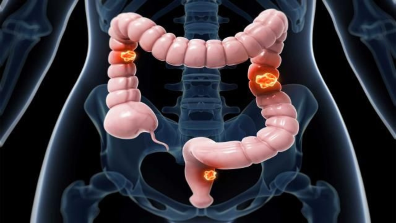 The Common Colon Cancer Sign You Need To Look Out For | Health and Me