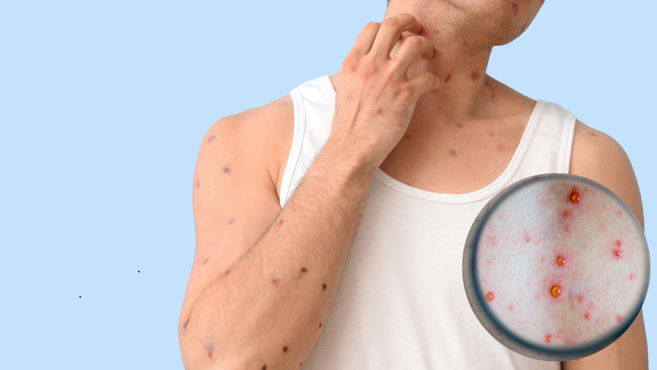 Mpox Outbreak: First Case of Severe Strain Reported in New York City ...