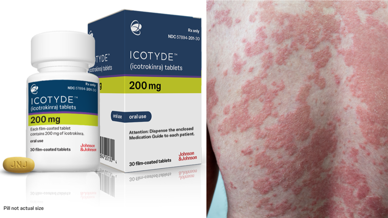 Icotyde: US FDA Approves Johnson & Johnson's Pill For Psoriasis ...
