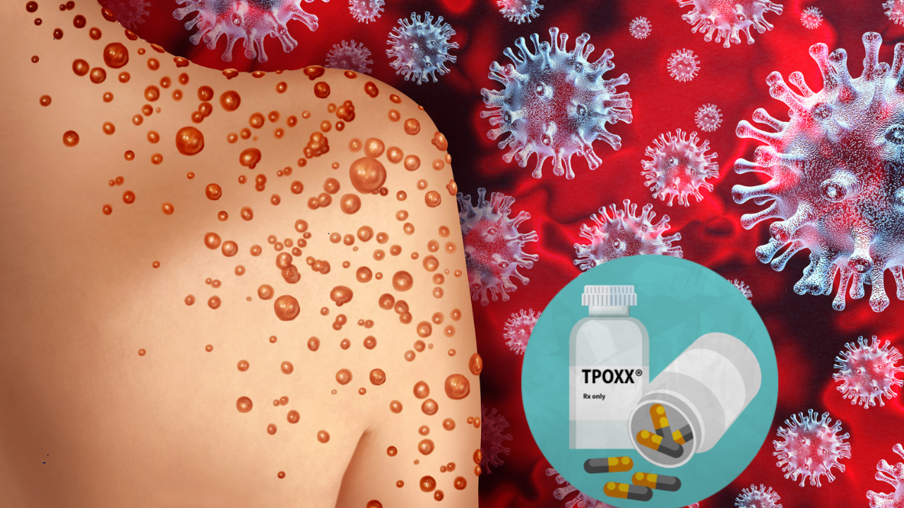 Tpoxx Should No Longer Be Used For Treating Mpox: European Drug ...