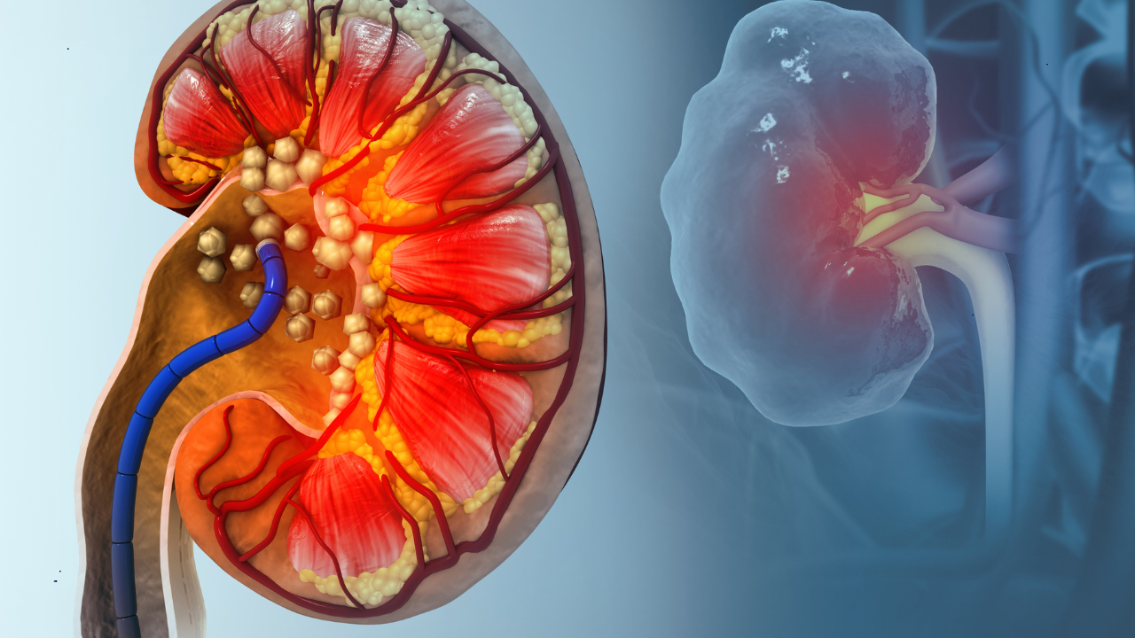 Kidney Stones Surge In Summer: What’s Driving The Seasonal Spike ...