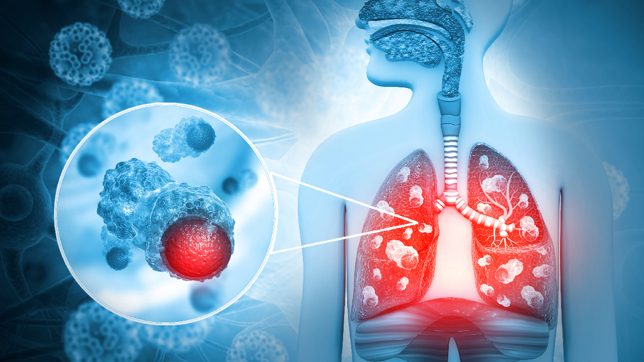 Lung Cancer Risk May Be Detected With Blood Marker 5 Years In Advance ...